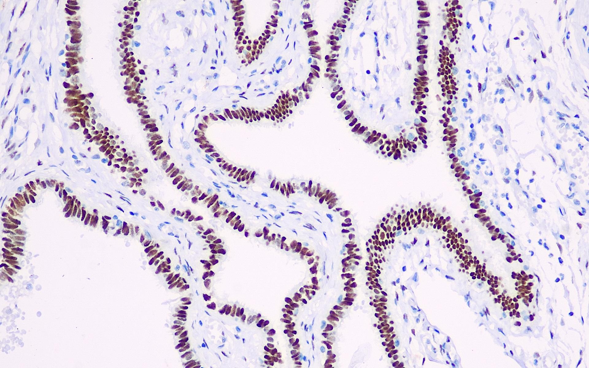 WT1抗体试剂-一抗-广州安必平医药科技股份有限公司-肿瘤-筛查与诊断-LBP-PCR-IHC-FISH