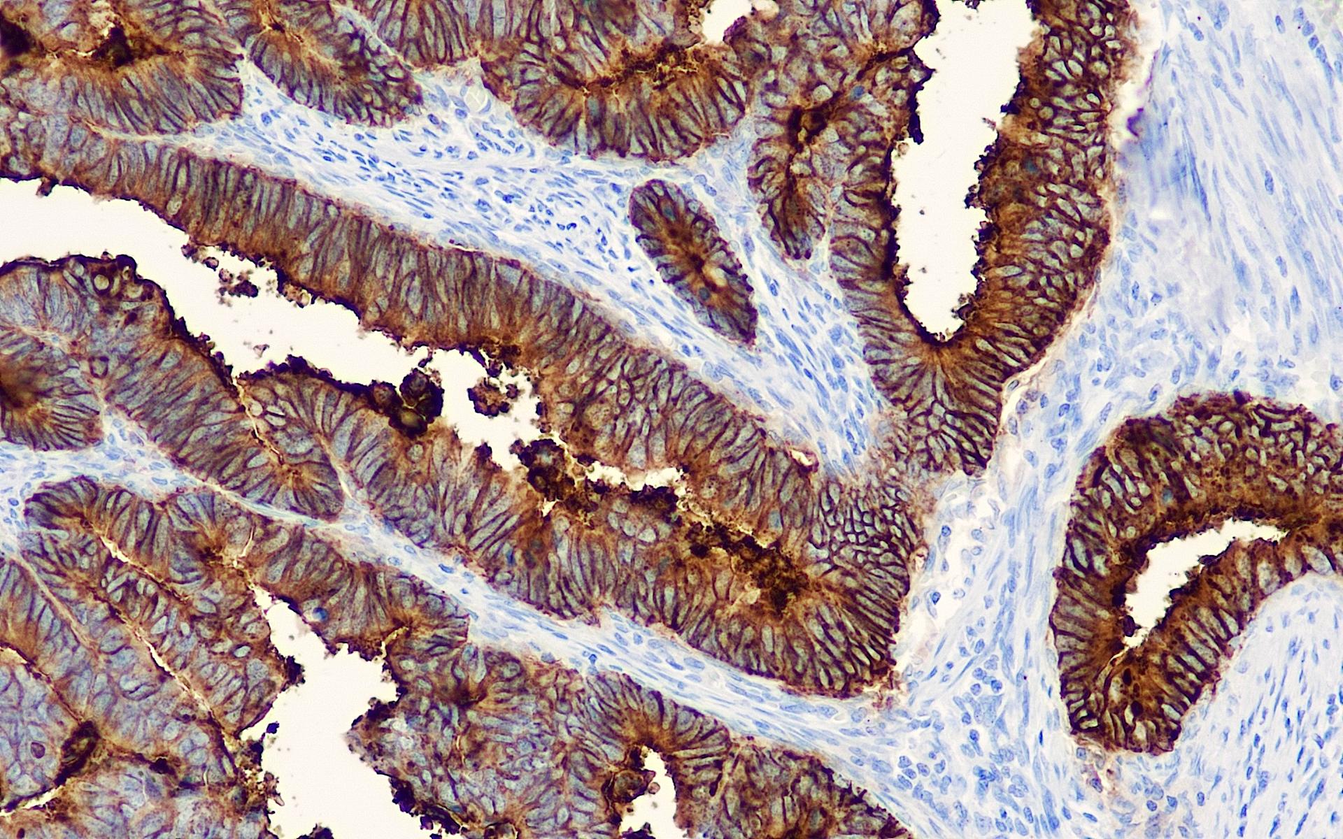 CEA 癌胚抗原 （LBP1-CEA）-一抗-广州安必平医药科技股份有限公司-肿瘤-筛查与诊断-LBP-PCR-IHC-FISH